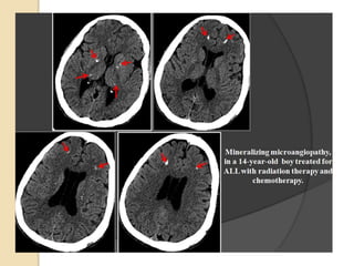 intracerebral calcification | PPTX