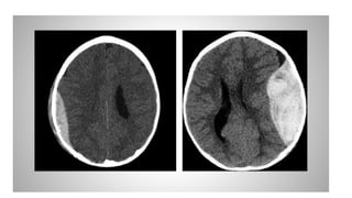 Brain Computed tomography.interpretation of brain ct | PPT