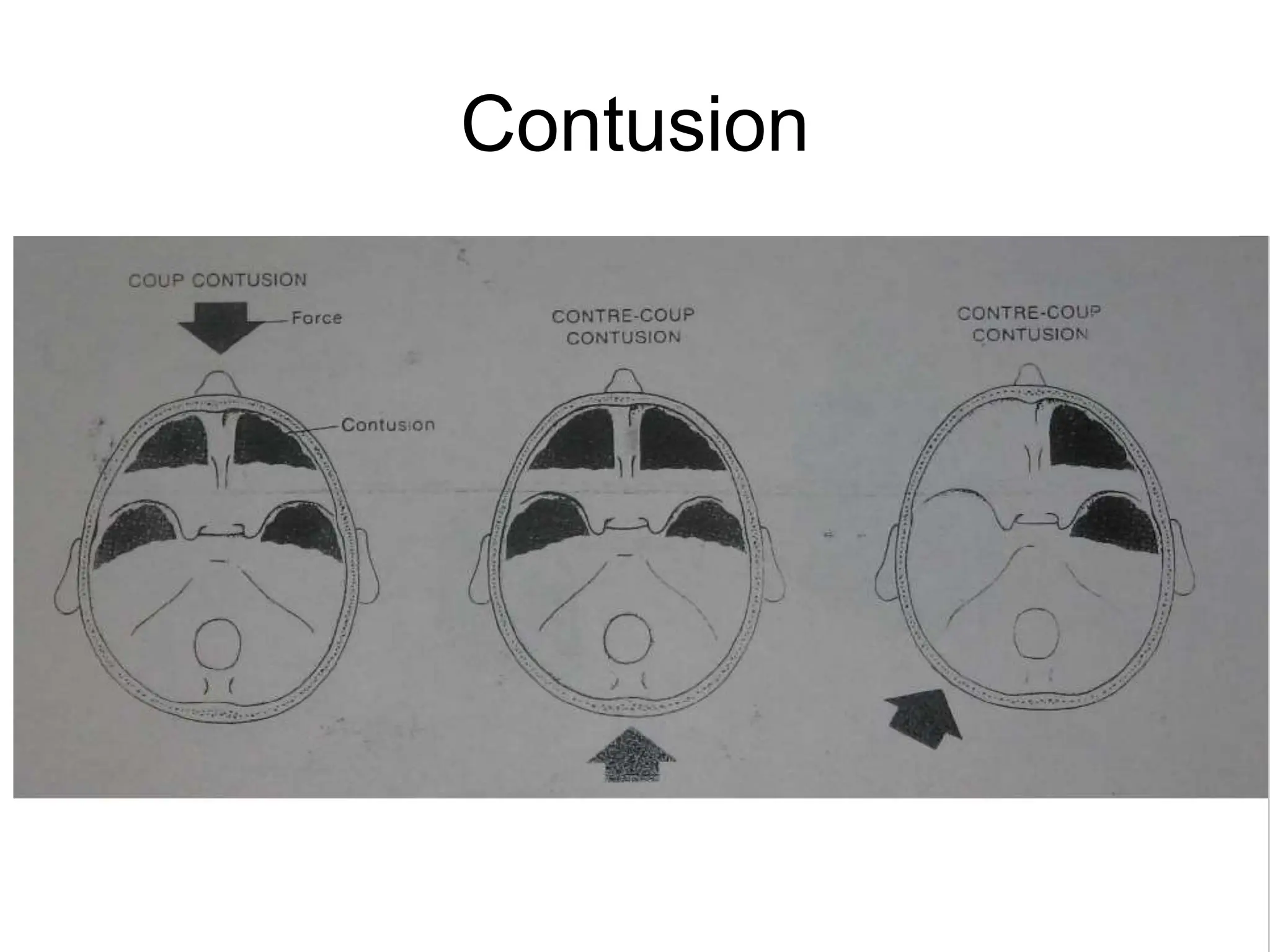 Brain Contusions.ppt.................... | PPT