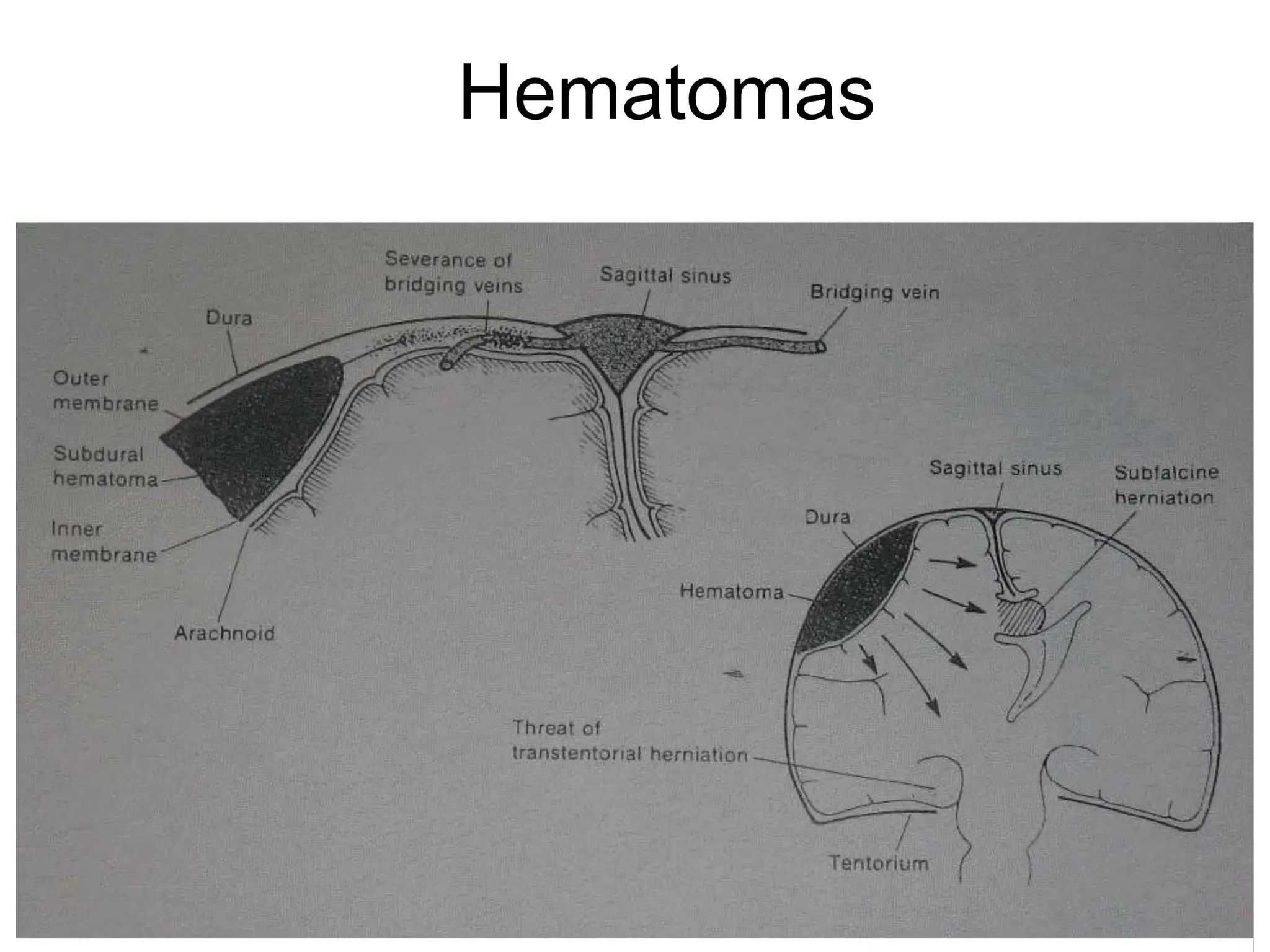 Brain Contusions.ppt.................... | PPT