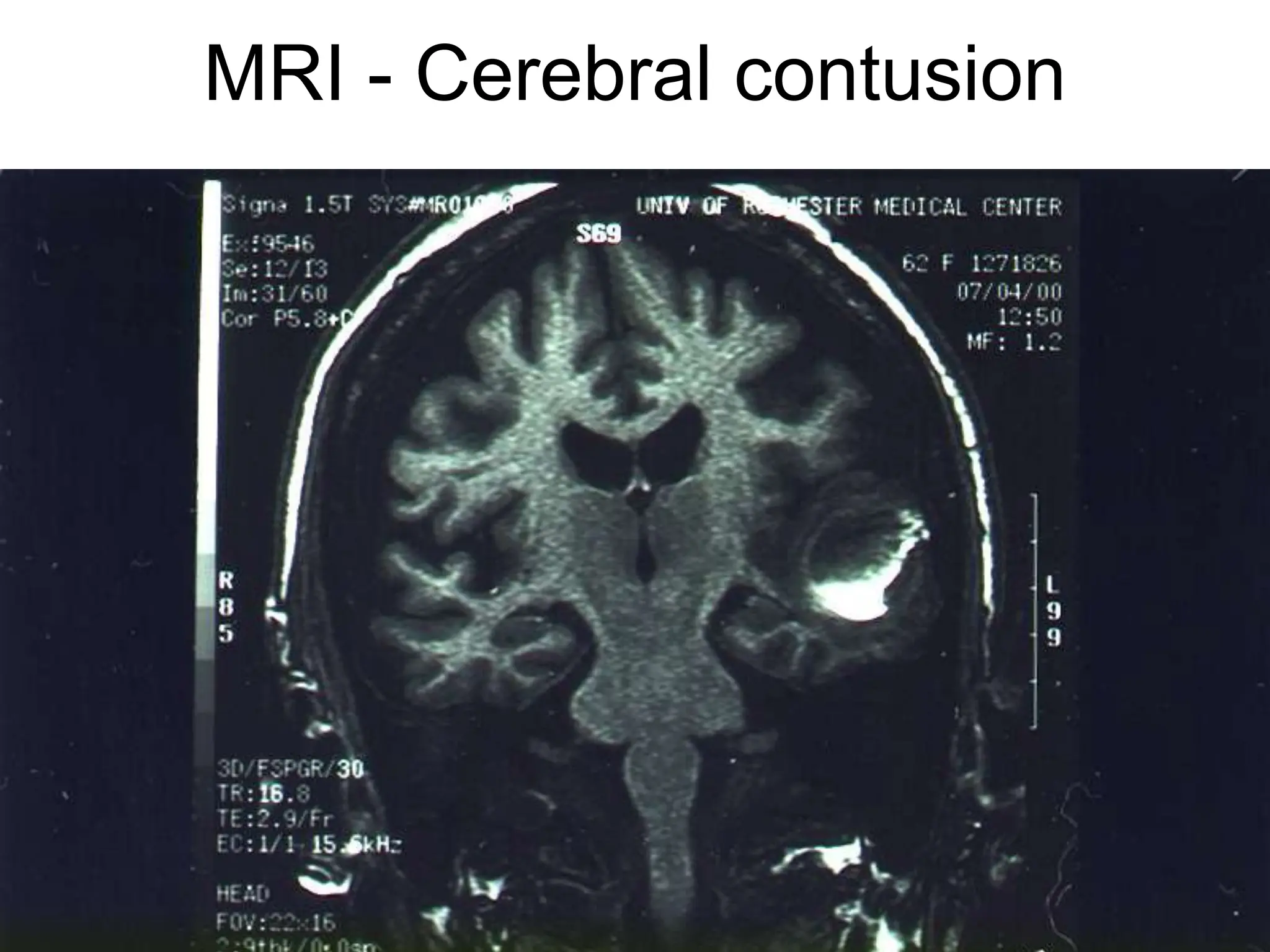 Brain Contusions.ppt.................... | PPT | Death, Injury, or ...