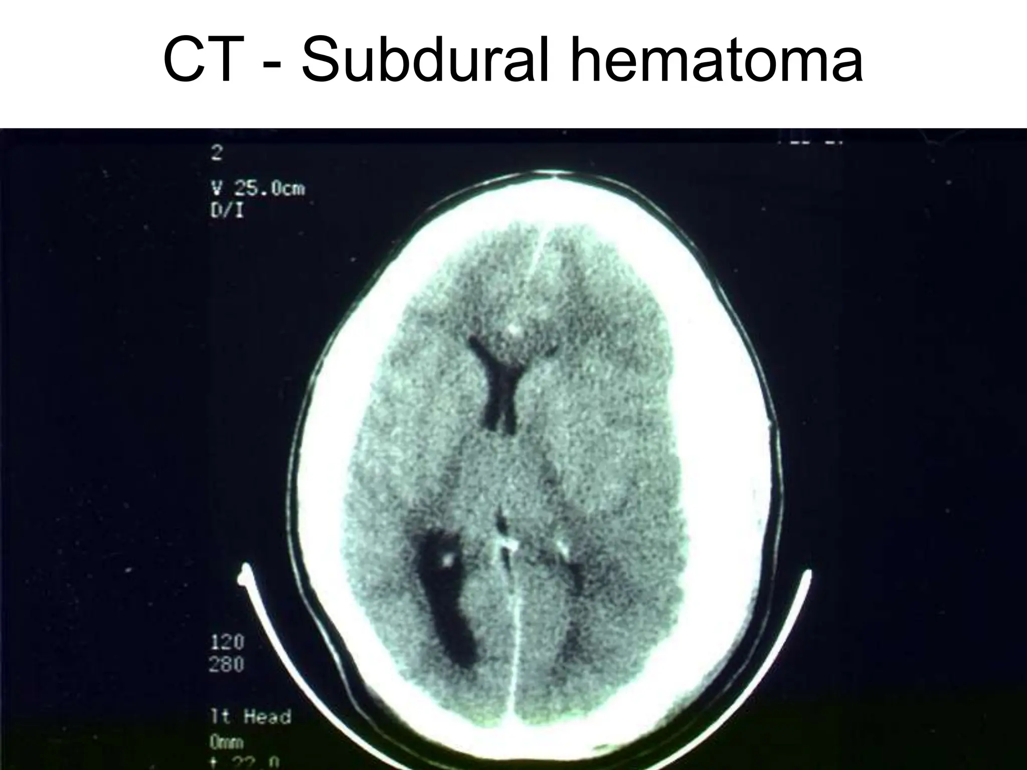 Brain Contusions.ppt.................... | PPT