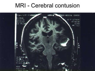 Brain Contusions.ppt.................... | PPT