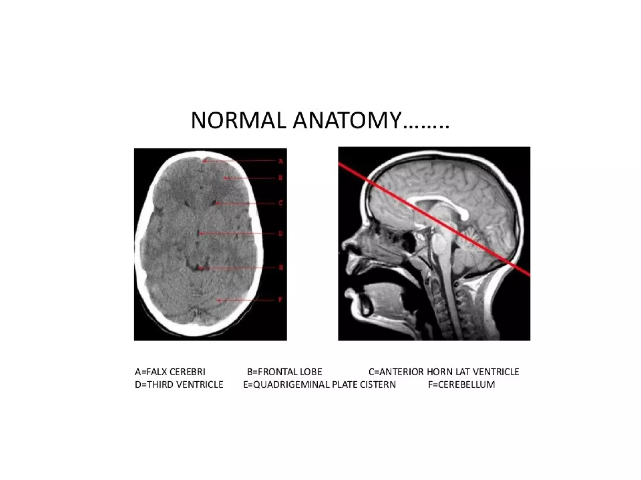 Brain CT Anatomy and Basic Interpretation Part I | PPT