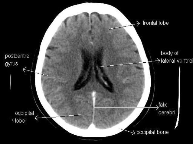 Brain CT Anatomy and Basic Interpretation Part II