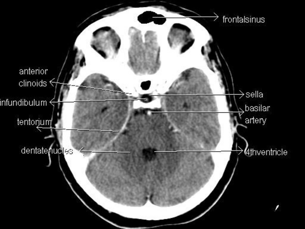 Brain Ct Anatomy And Basic Interpretation Part Ii