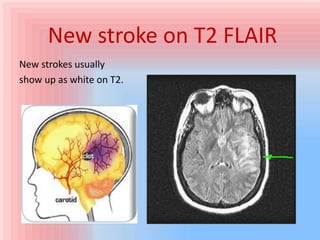 Brain ct and mri in icu | PPTX