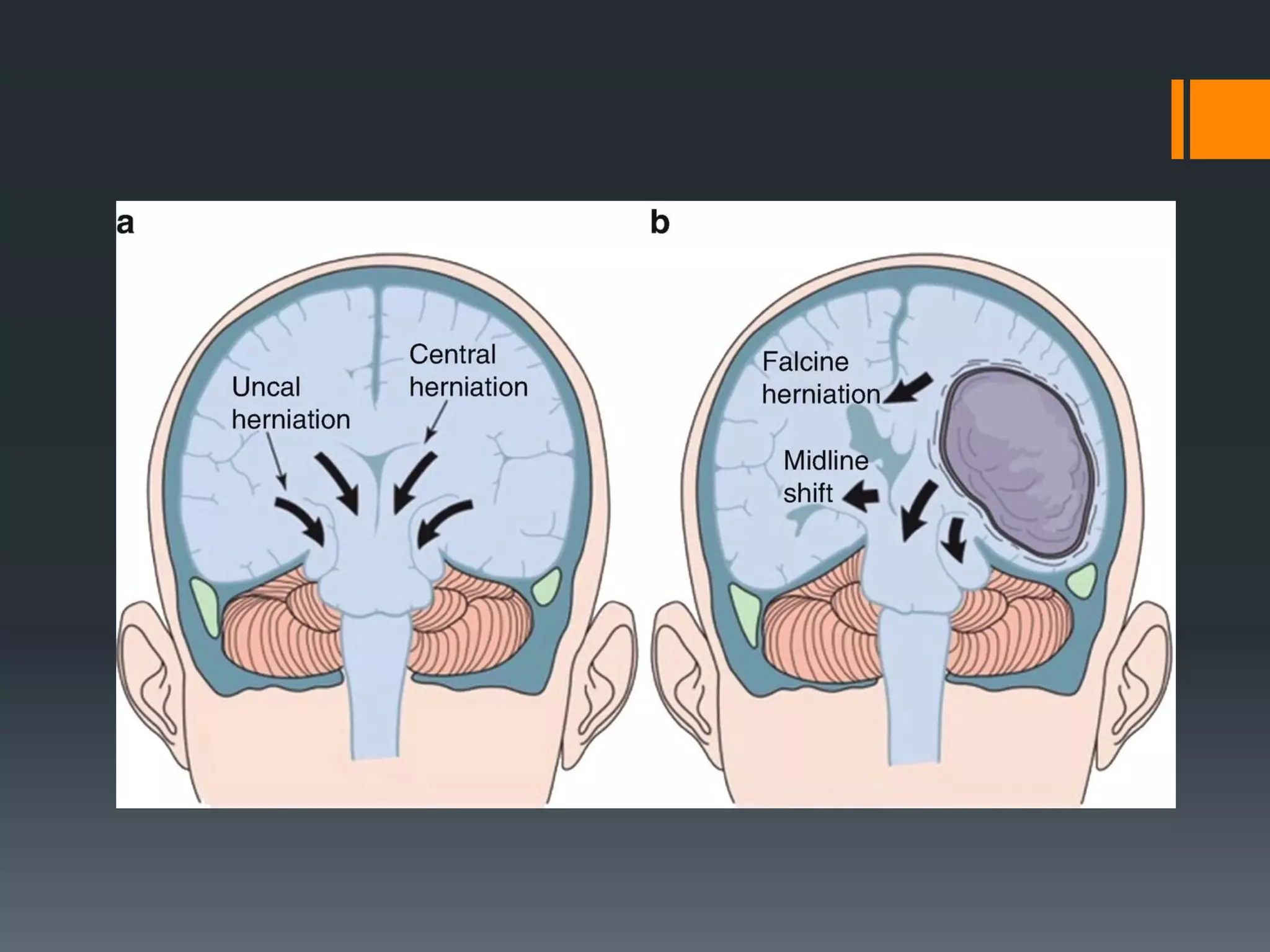 Brain ct interpretation.pdf