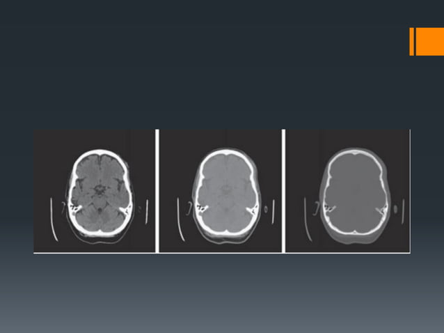 Brain ct interpretation.pdf | Brain and Nervous System Disorders ...