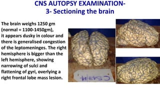 Brain cut up for the general pathologist | PPT