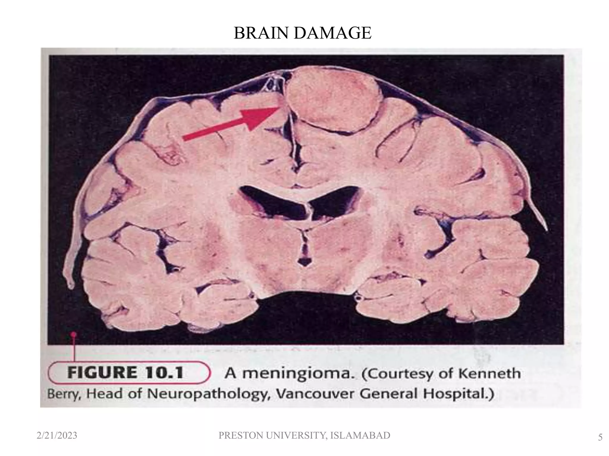 Brain Damage.pptx