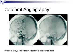 Brain death | PPT