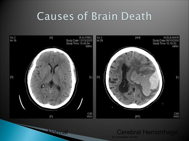 Brain death assessment basic principles | PPT | Brain and Nervous ...