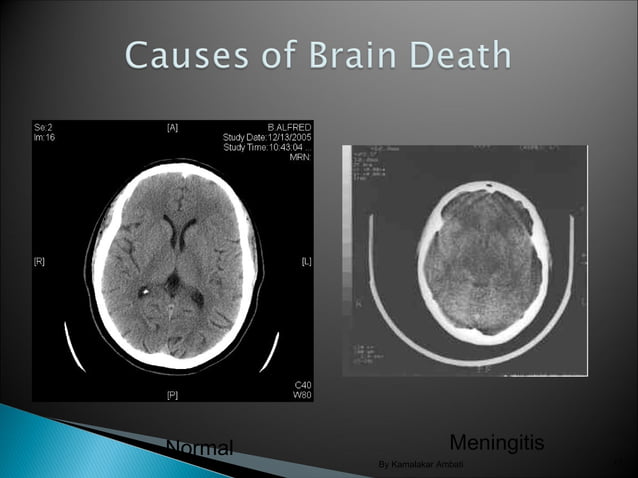 Brain death assessment basic principles | PPT | Brain and Nervous ...