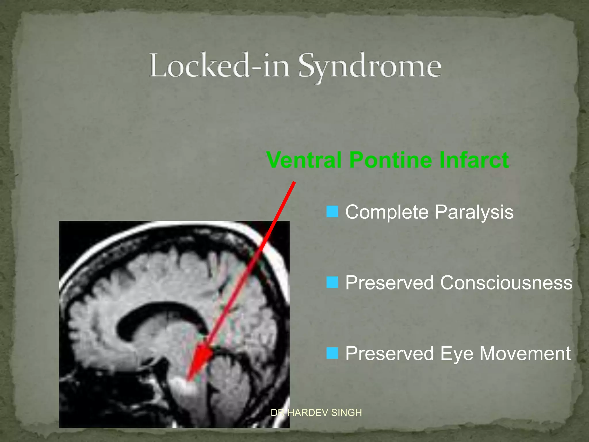 Brain death | PPT | Brain and Nervous System Disorders | Diseases and ...