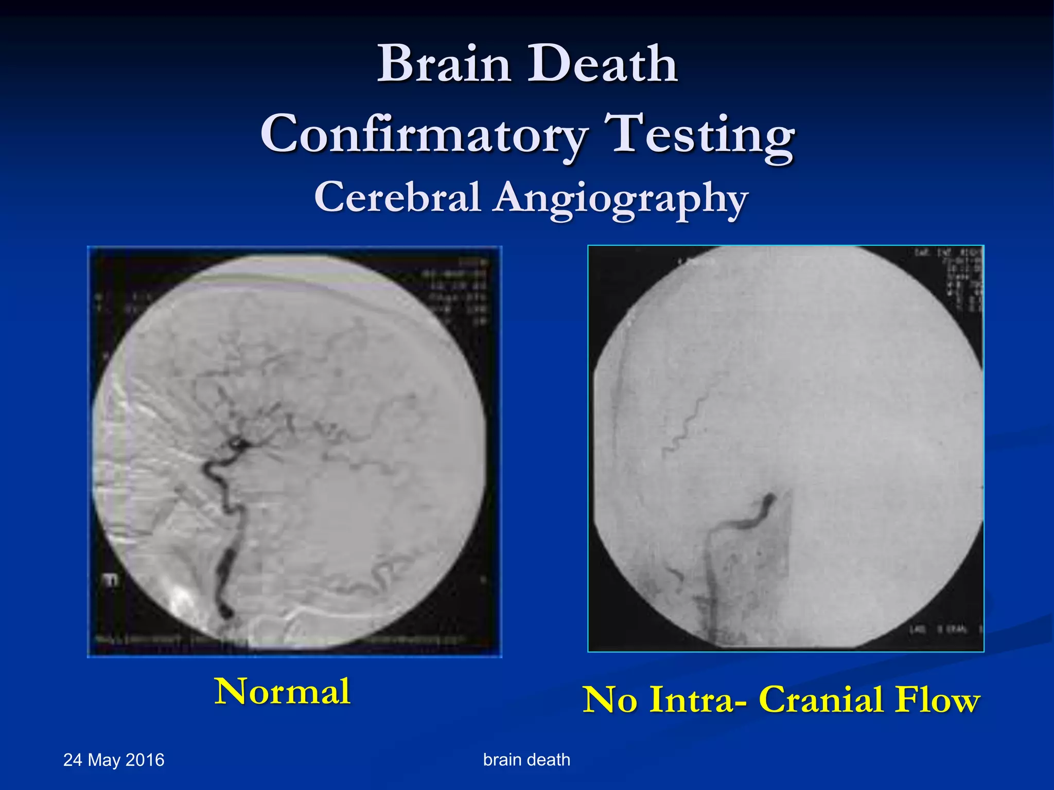 Brain death presentation | PPTX
