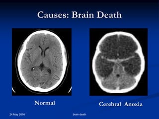 Brain death presentation | PPTX