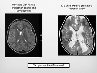 Cerebral Palsy Brain Scan Comparison