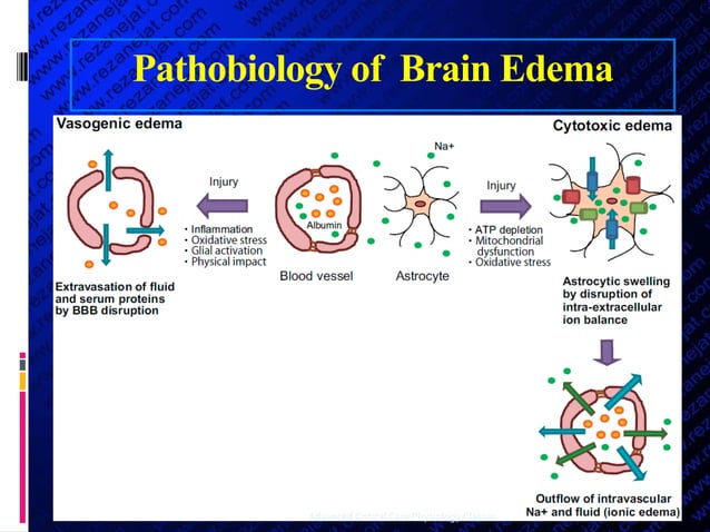 Brain edema23 | PDF