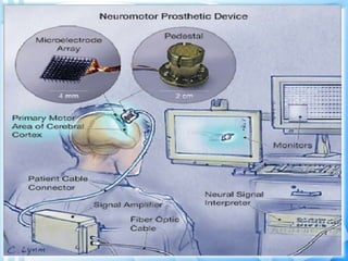 Brain Gate System | PPT
