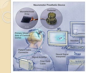 Brain gate- thoughts into actions | PPTX | Brain and Nervous System Disorders | Diseases and ...