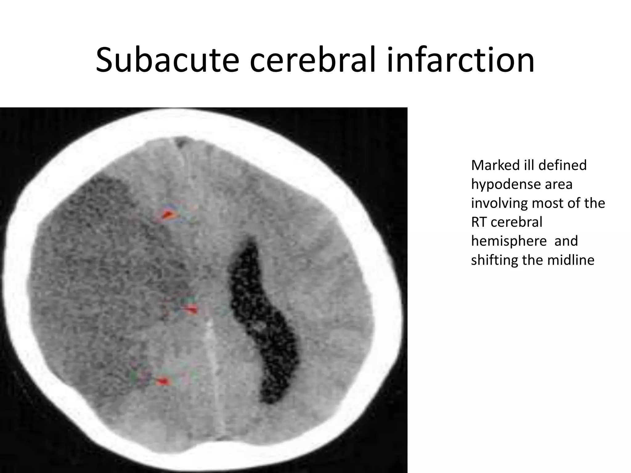 Radiology of Brain hemorrhage vs infarction | PPTX