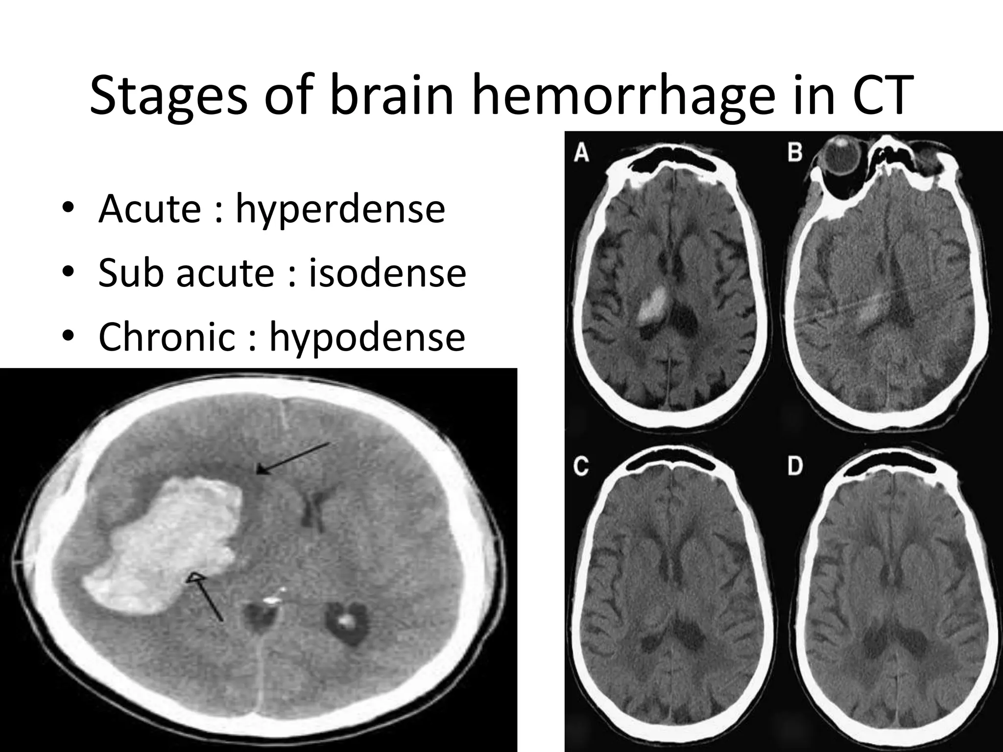 Radiology of Brain hemorrhage vs infarction | PPTX
