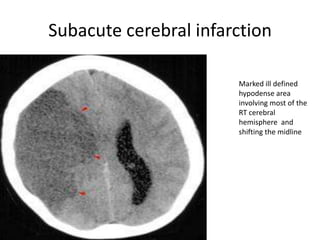 Radiology of Brain hemorrhage vs infarction | PPTX