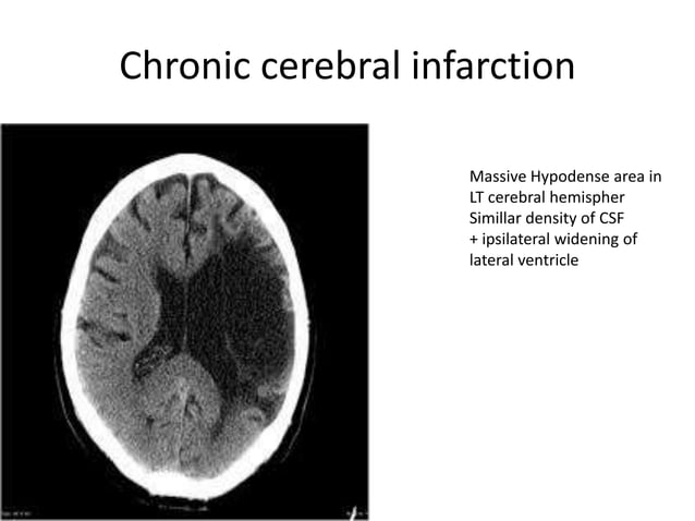 Radiology of Brain hemorrhage vs infarction | PPTX | Death, Injury, or ...