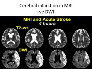 Radiology of Brain hemorrhage vs infarction | PPTX