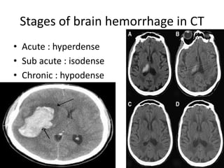 Ischemic Vs Hemorrhagic Stroke Mri