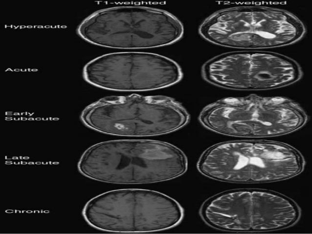 Radiology of Brain hemorrhage vs infarction