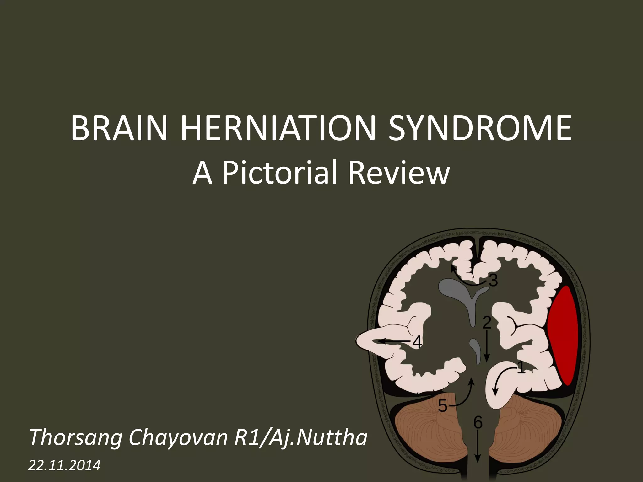 Brain herniation imaging | PDF