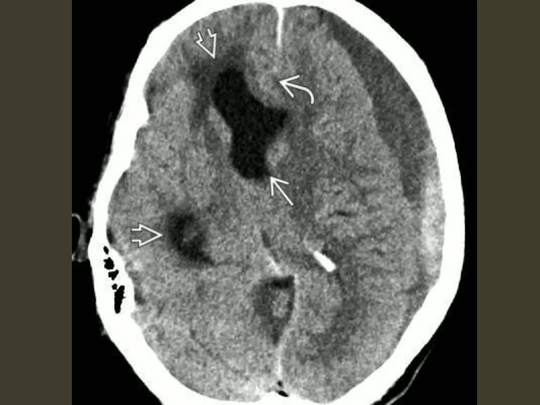 Brain herniation imaging | PDF