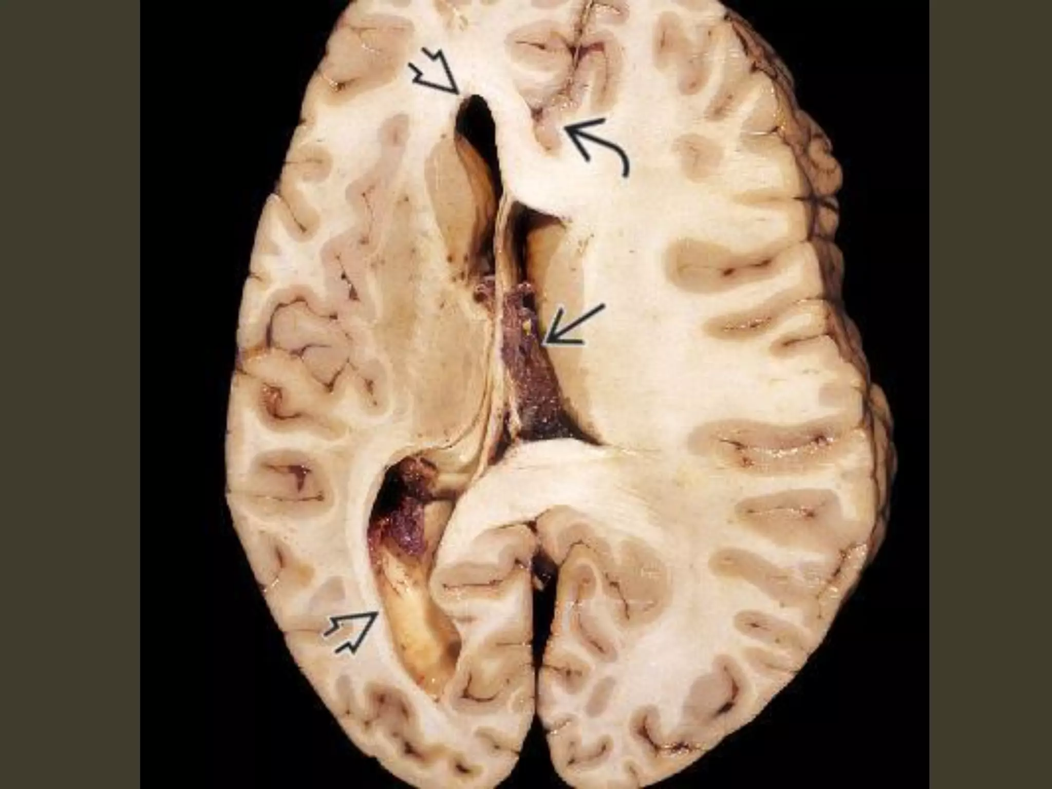 Brain herniation imaging | PDF