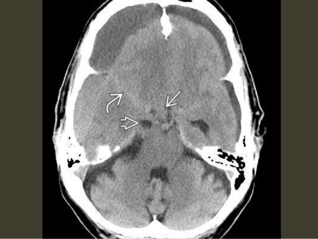 Brain herniation imaging