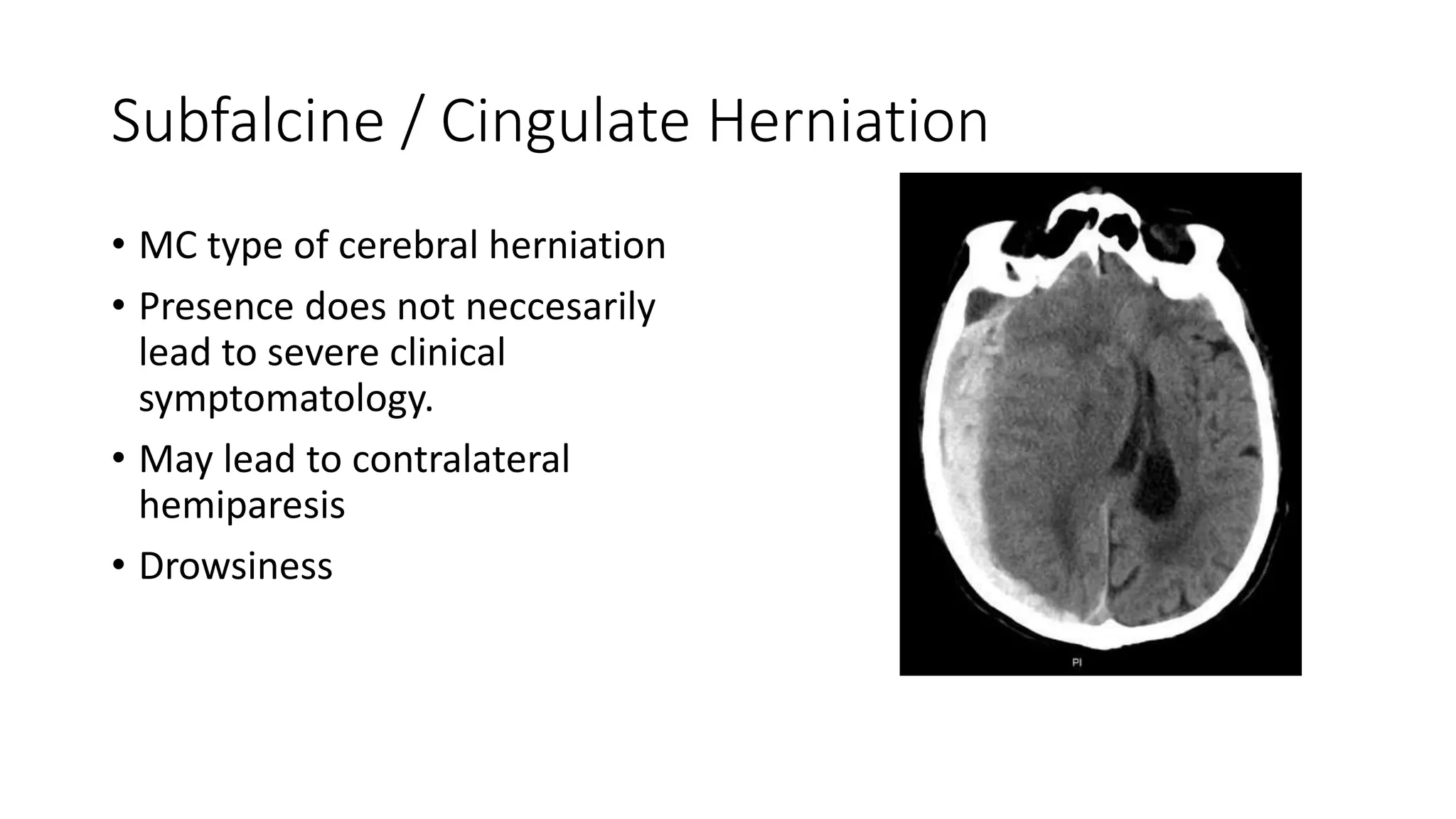 Brain herniation | PPTX