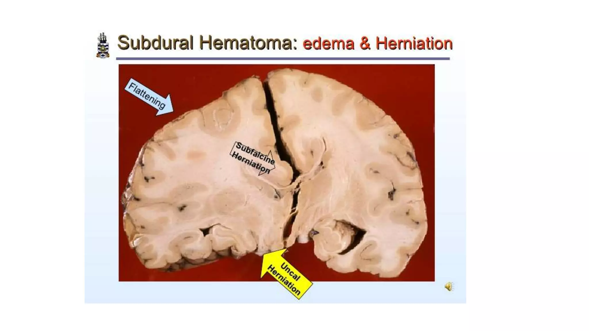 Brain herniation | PPTX