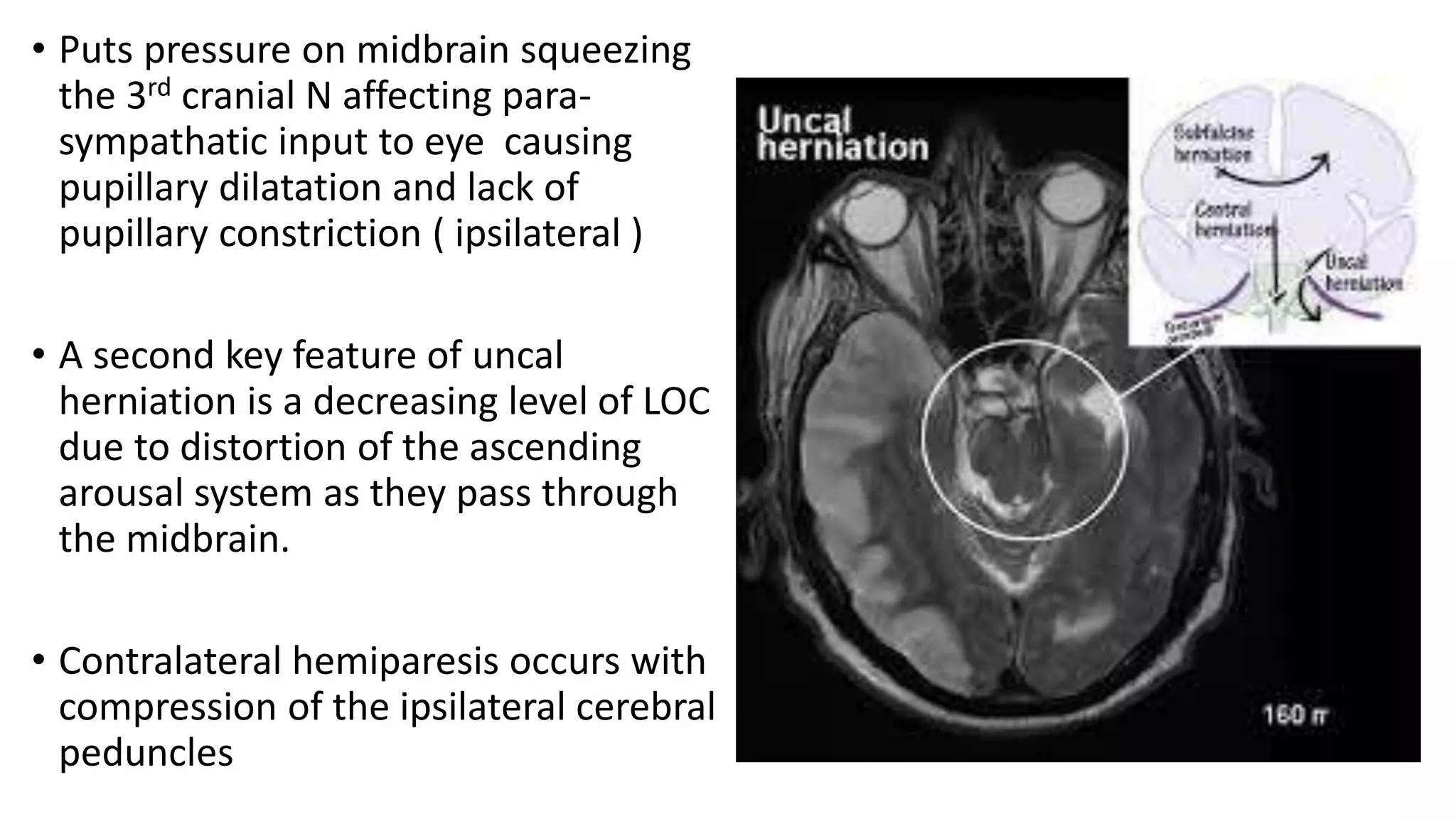 Brain herniation | PPTX