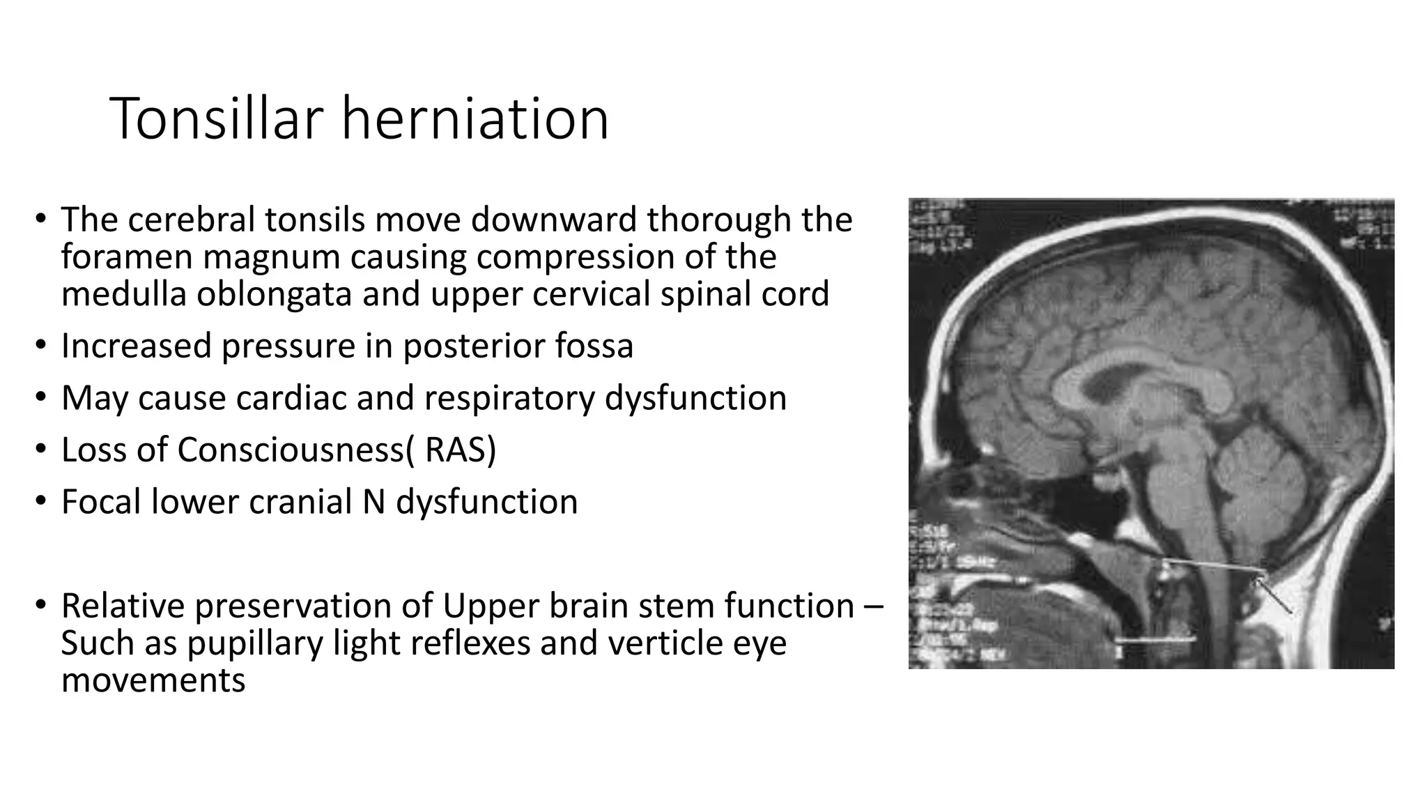 Brain herniation | PPTX