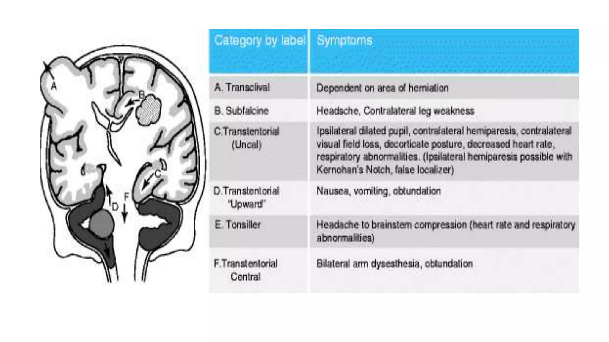 Brain herniation | PPTX
