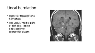 Brain herniation | PPTX