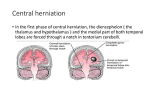 Brain herniation | PPTX | Death, Injury, or Military Conflict ...