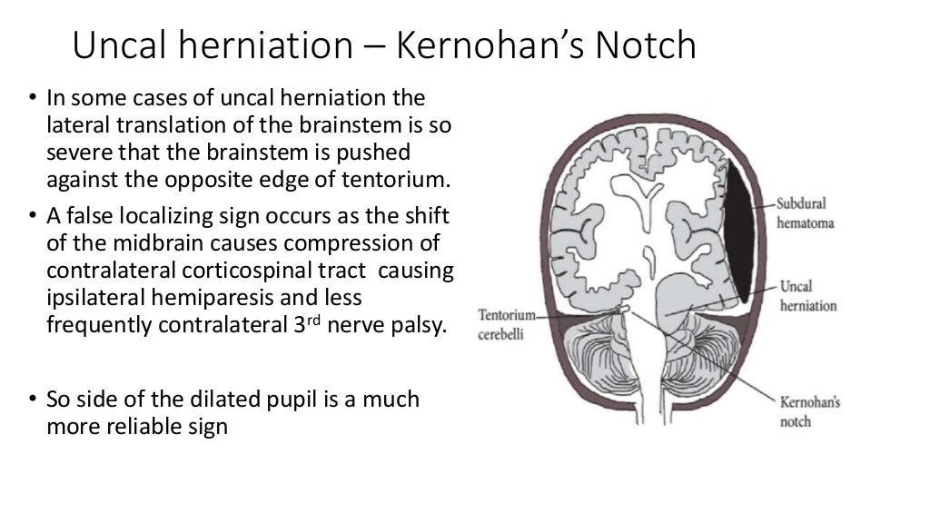 Brain herniation
