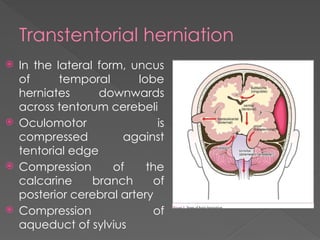 BRAIN HERNIATION LECTURES IN ANATOMICAL PATHOLOGY.pptx