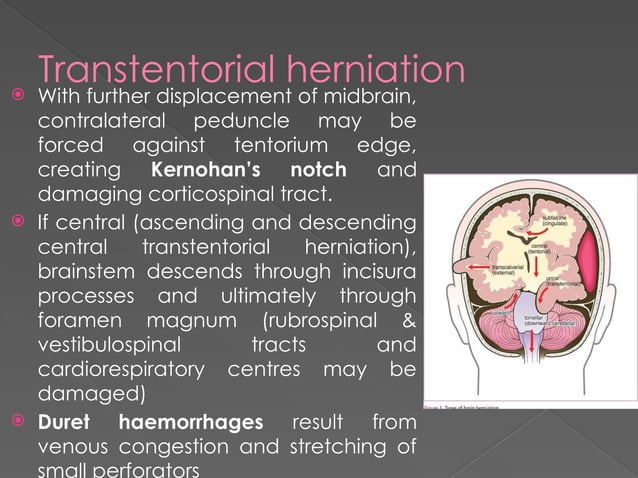 BRAIN HERNIATION LECTURES IN ANATOMICAL PATHOLOGY.pptx