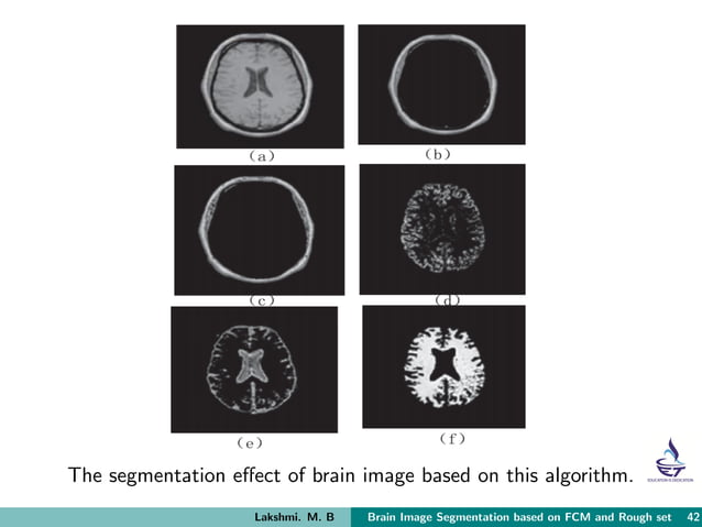 Brain image segmentation based on FCM Clustering Algorithm and Rough Set | PPT