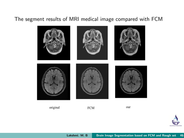 Brain image segmentation based on FCM Clustering Algorithm and Rough ...
