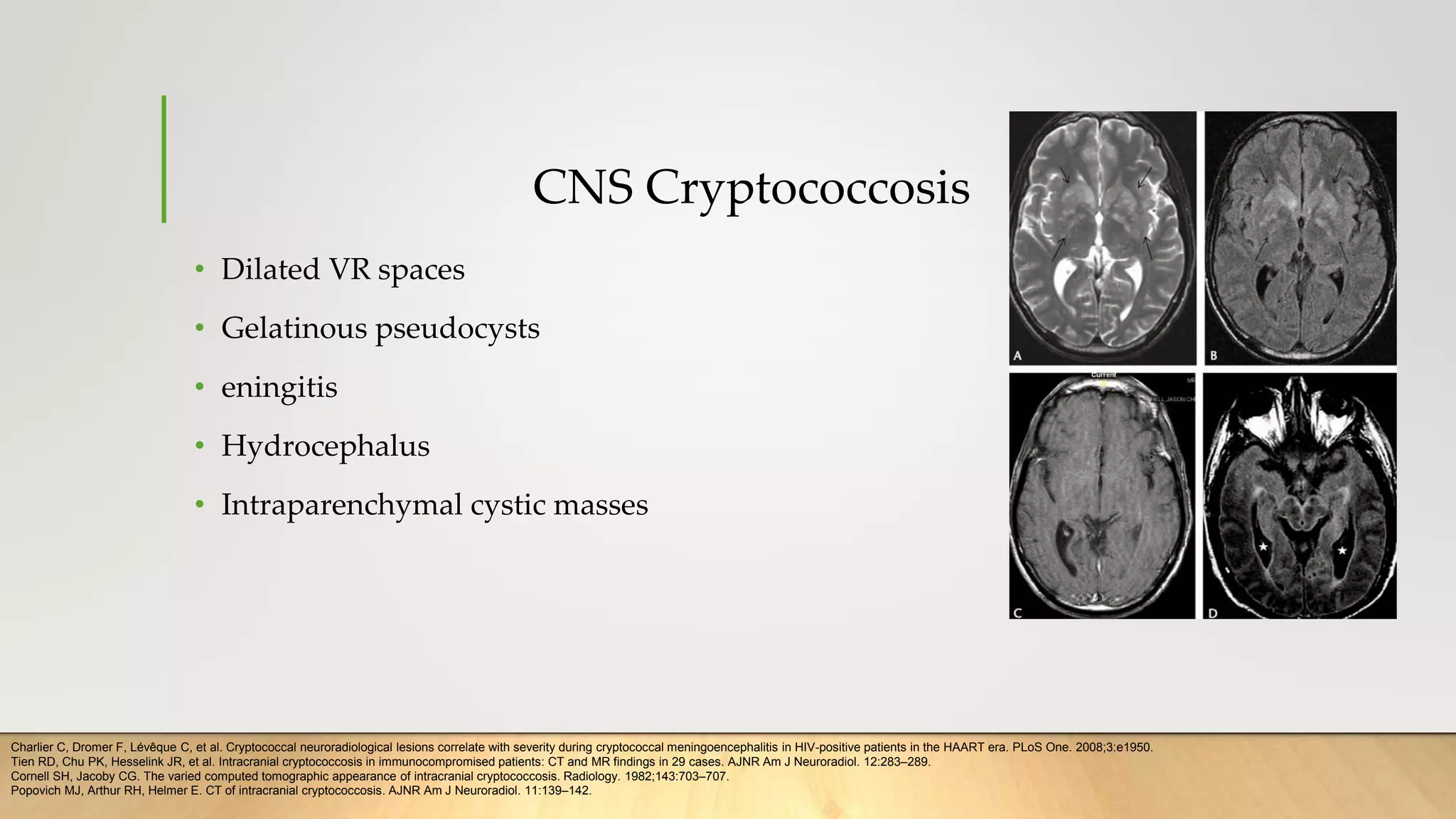 Brain Imaging in Patients with HIV Infection | PPTX