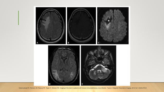 Brain Imaging in Patients with HIV Infection | PPTX | Brain and Nervous ...